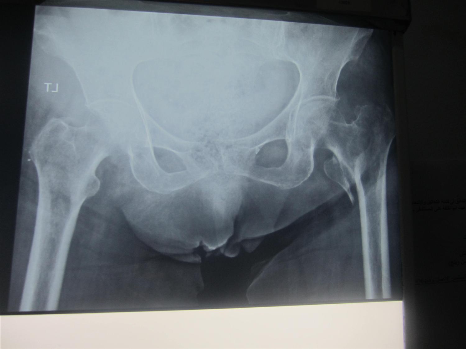 Intertrochanteric Fractures - Trauma - Orthobullets