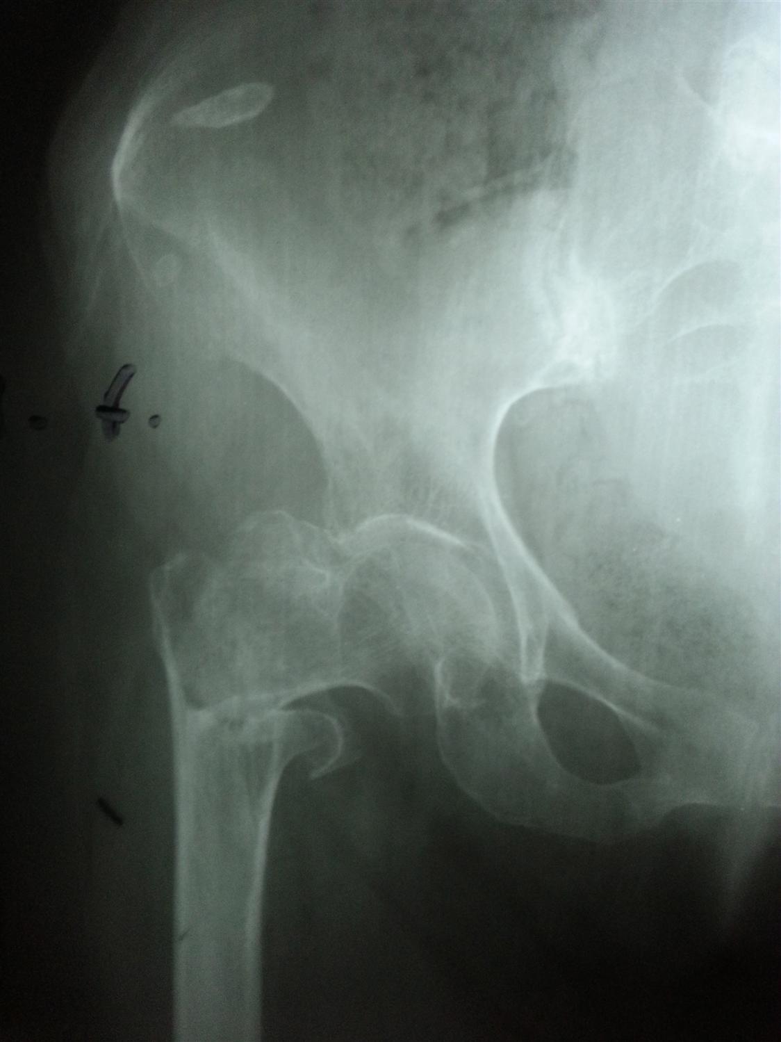 Intertrochanteric Fractures - Trauma - Orthobullets