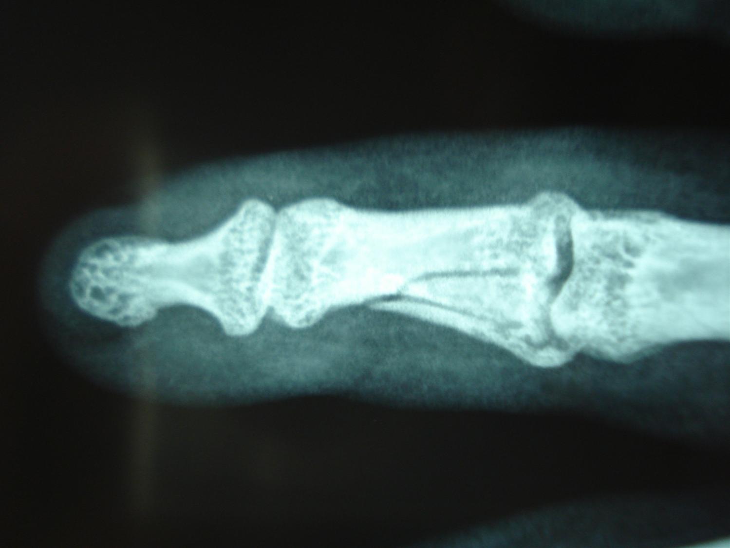 Phalanx Dislocations - Hand - Orthobullets