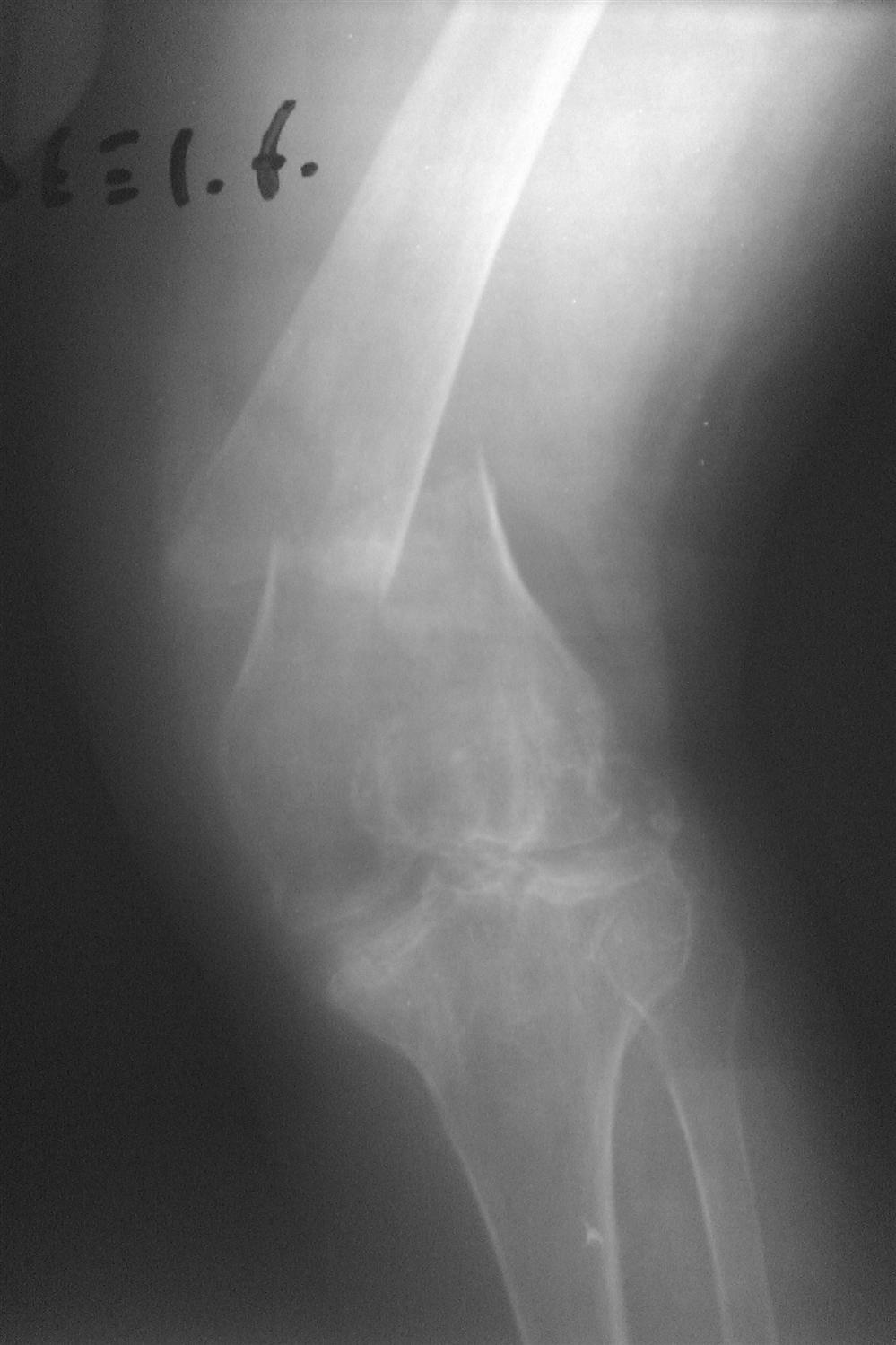Distal Femur