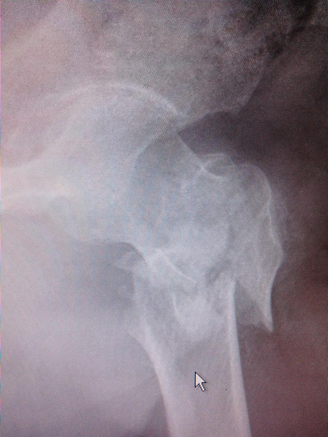 Intertrochanteric Fractures - Trauma - Orthobullets