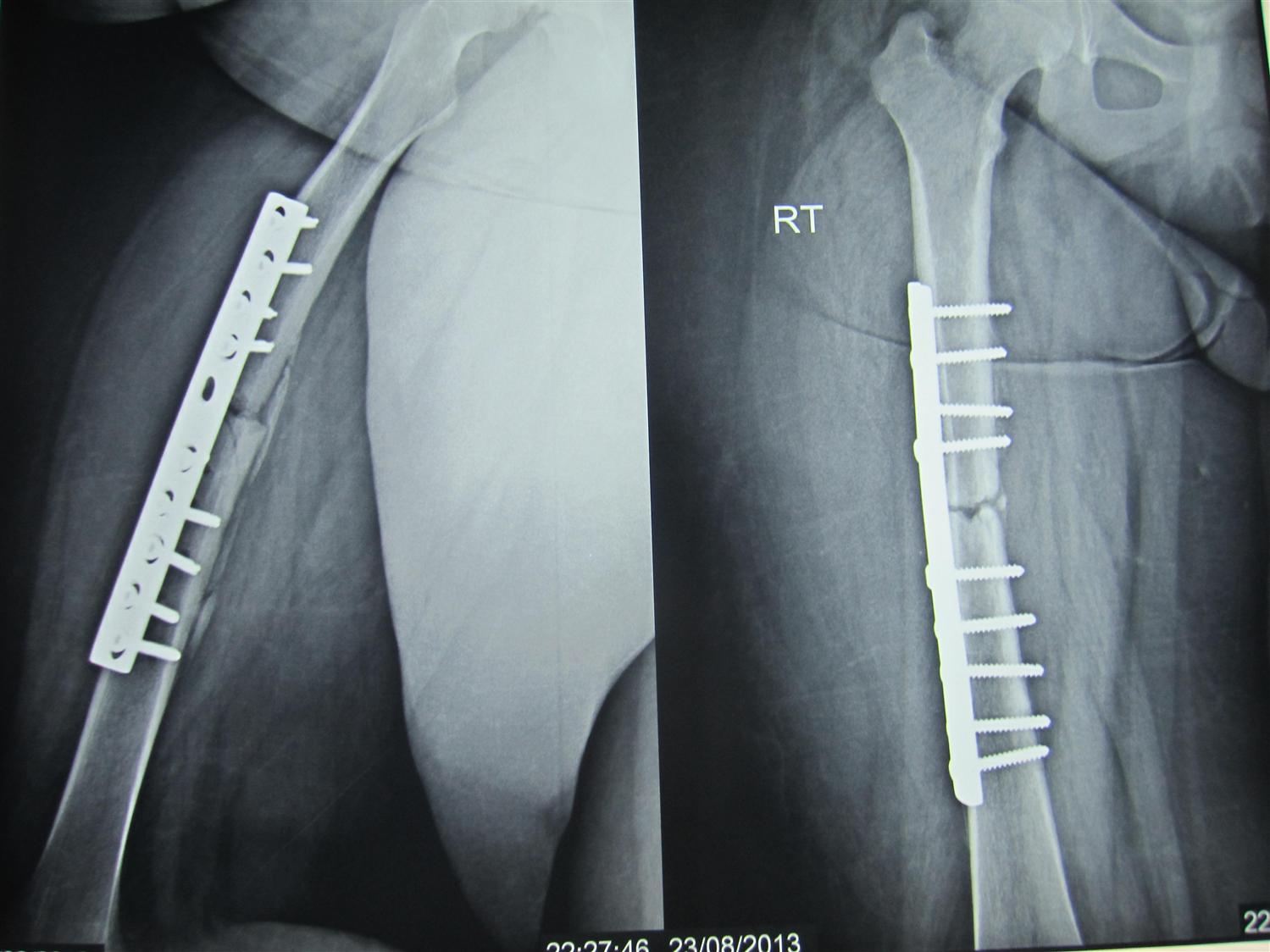 Femoral Shaft Fractures - Trauma - Orthobullets.com