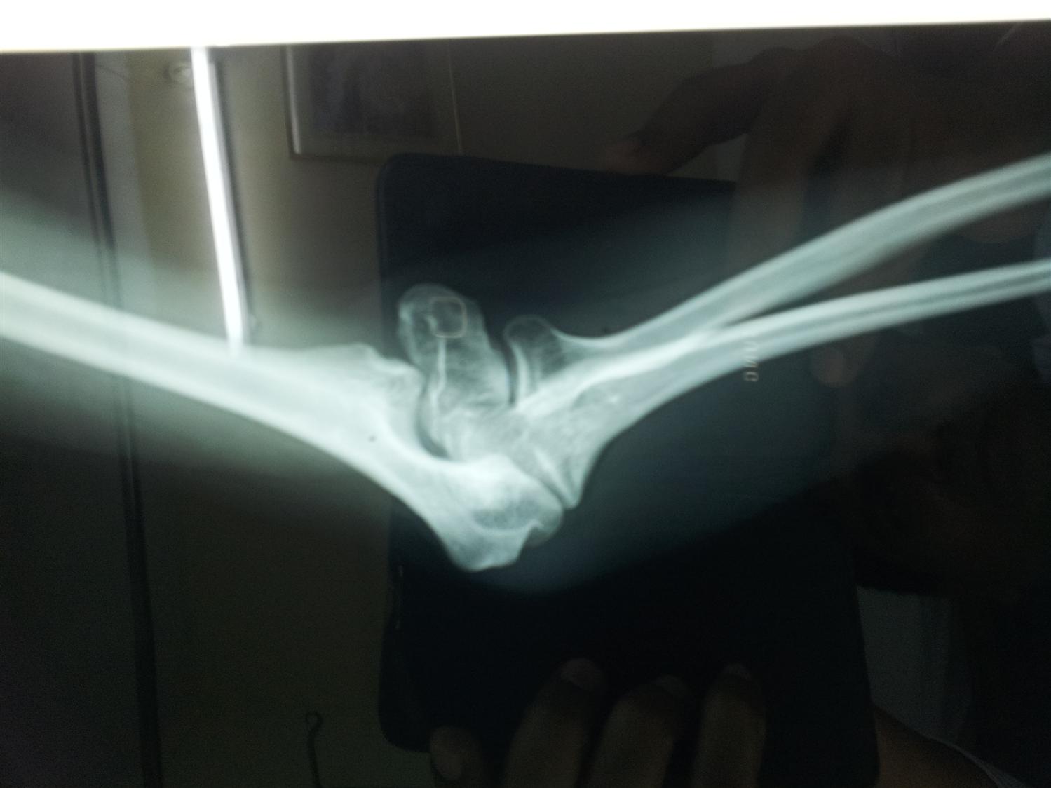 Distal Humerus Fractures - Trauma - Orthobullets