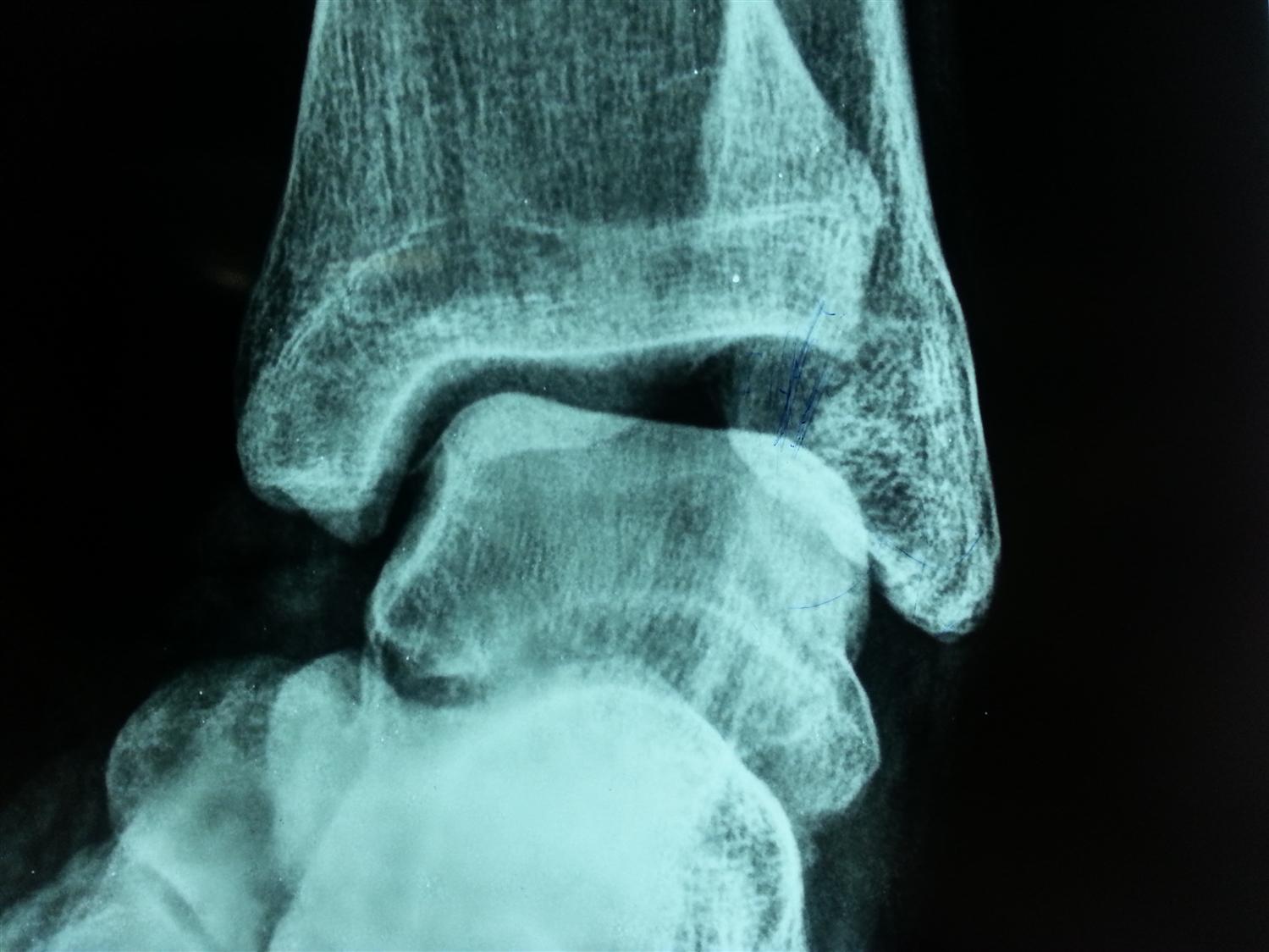 Ankle Ligaments Foot Ankle Orthobullets Ligament – Osteopathy