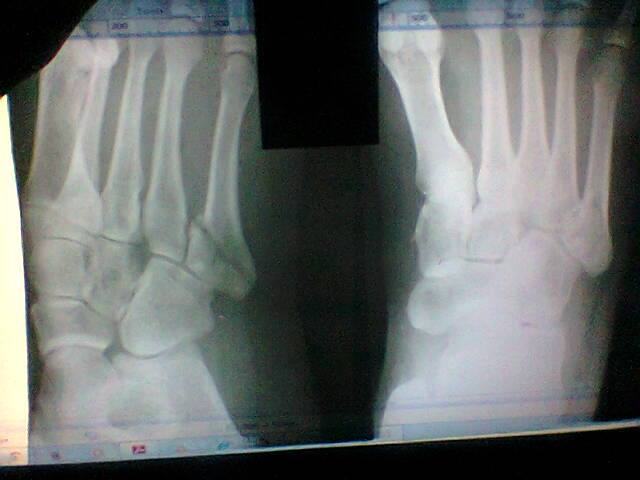 5th Metatarsal Base Fracture - Foot & Ankle - Orthobullets