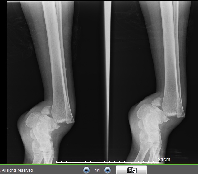 Ankle Fractures - Trauma - Orthobullets