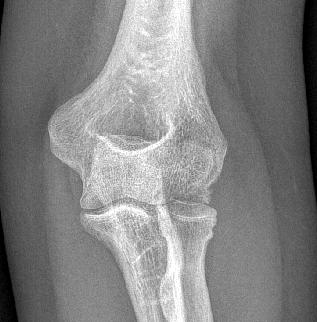 Capitellum Fractures - Trauma - Orthobullets