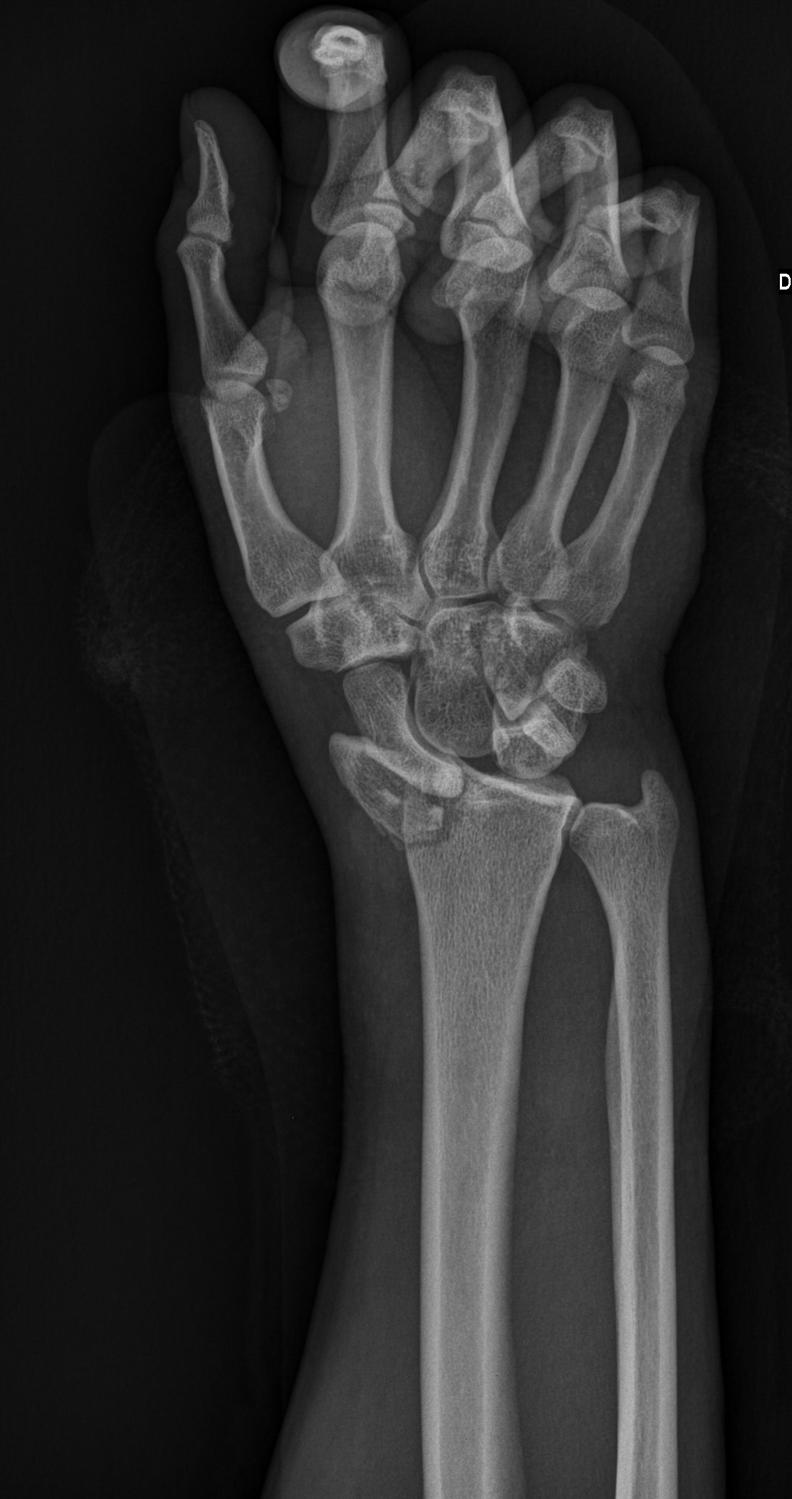 Lunate Dislocation (Perilunate dissociation) - Hand - Orthobullets