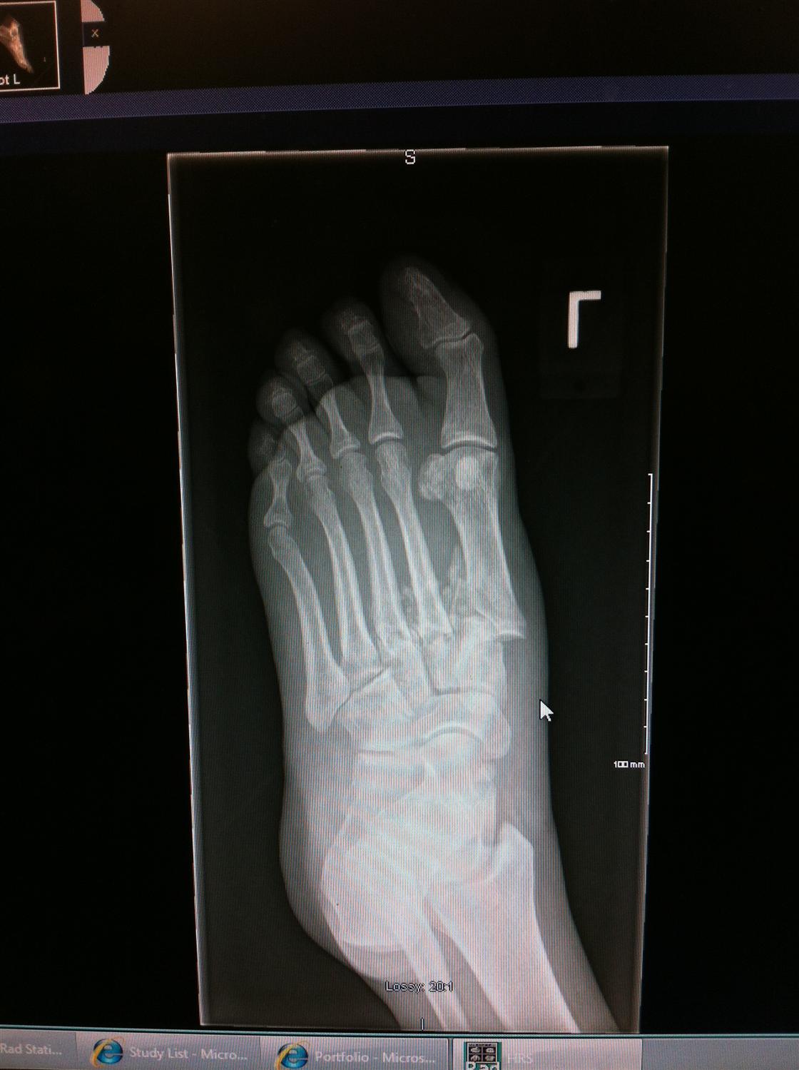 Diabetic Charcot Neuropathy - Foot & Ankle - Orthobullets
