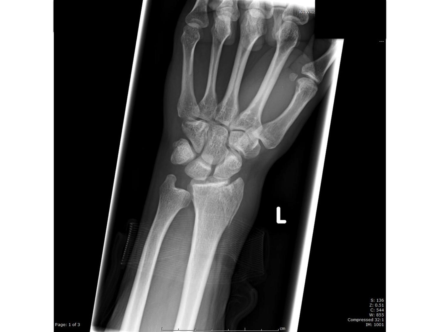 Distal Radius Fractures - Trauma - Orthobullets