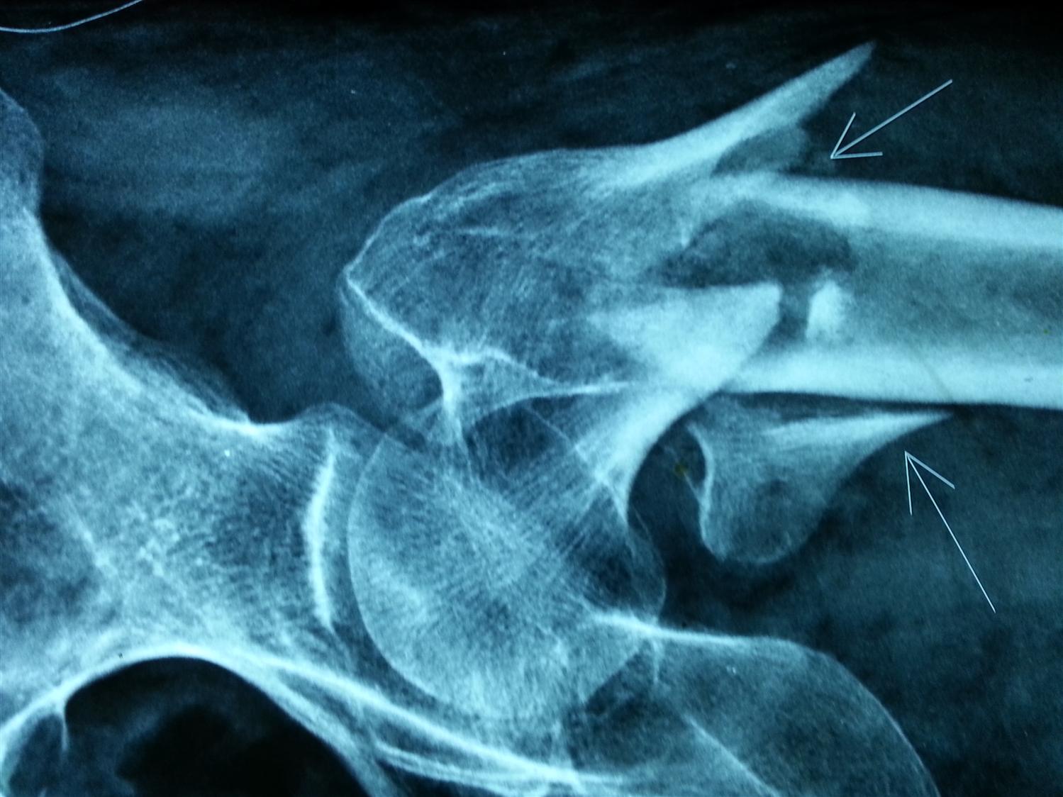 Subtrochanteric Fractures - Trauma - Orthobullets