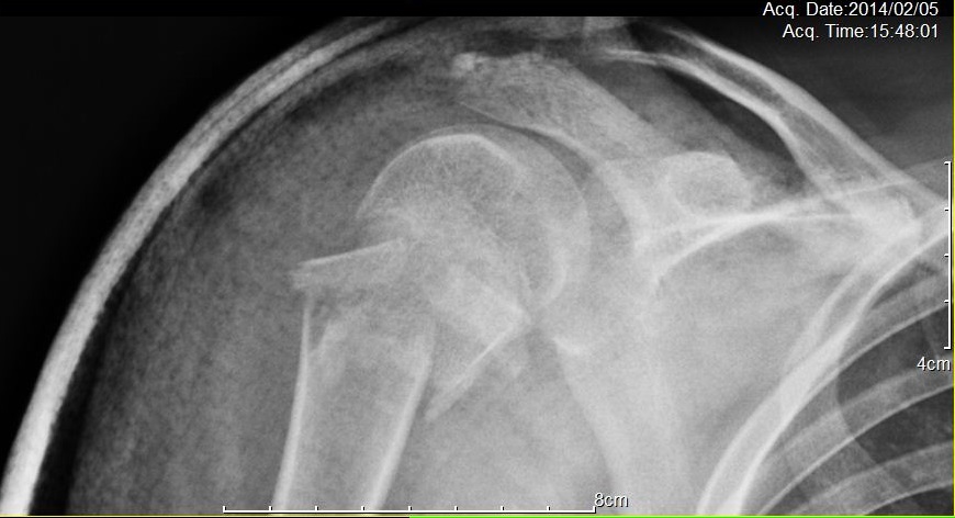 Proximal Humerus Fractures - Trauma - Orthobullets