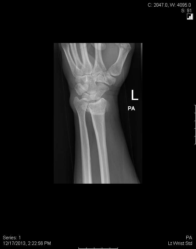 Distal Radius Fractures - Trauma - Orthobullets
