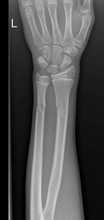 Radius and Ulnar Shaft Fractures - Trauma - Orthobullets