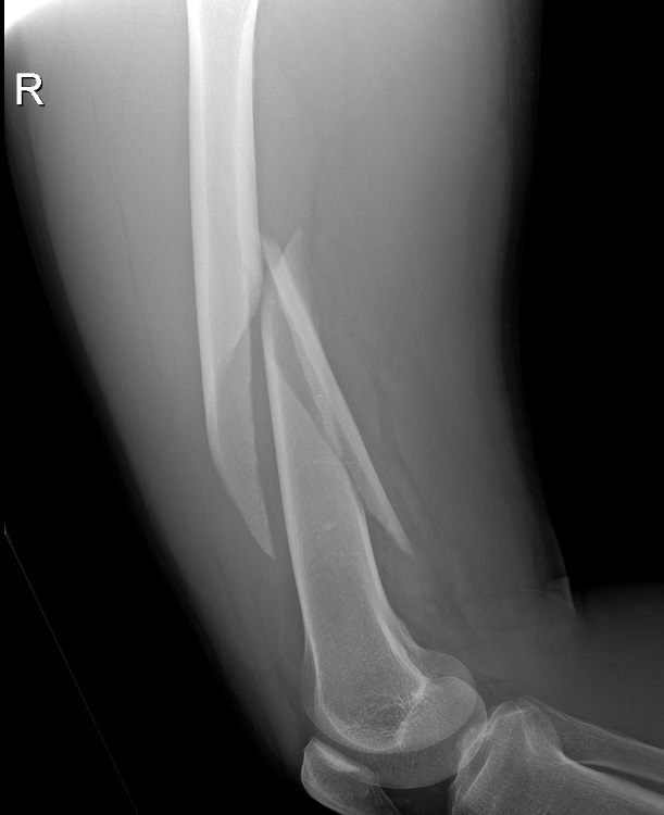 Fracture Healing - Basic Science - Orthobullets
