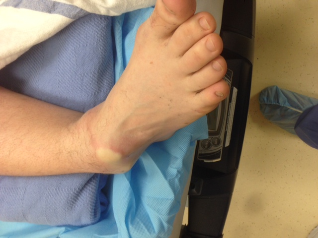 Subtalar Dislocations - Trauma - Orthobullets