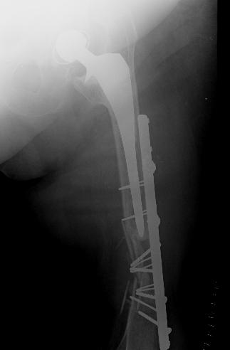 THA Periprosthetic Fracture - Recon - Orthobullets