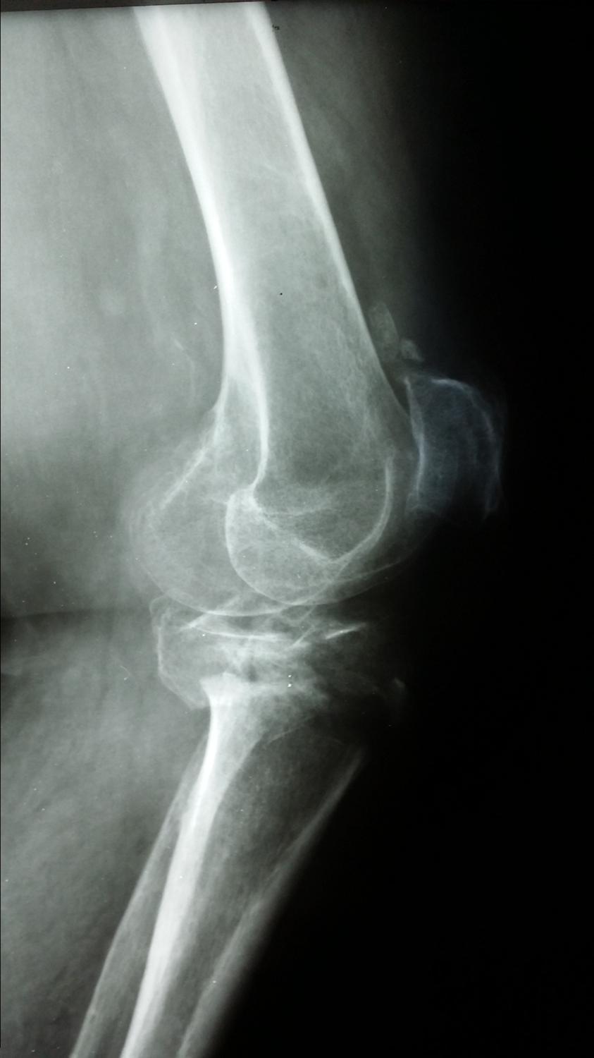 Proximal Third Tibia Fracture - Trauma - Orthobullets