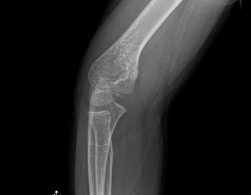 Distal Humerus Fractures - Trauma - Orthobullets