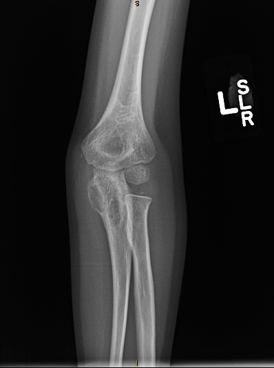Chondroblastoma - Pathology - Orthobullets