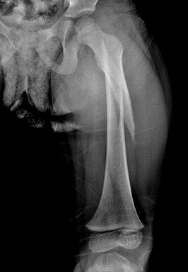 Femoral Shaft Fractures - Trauma - Orthobullets.com