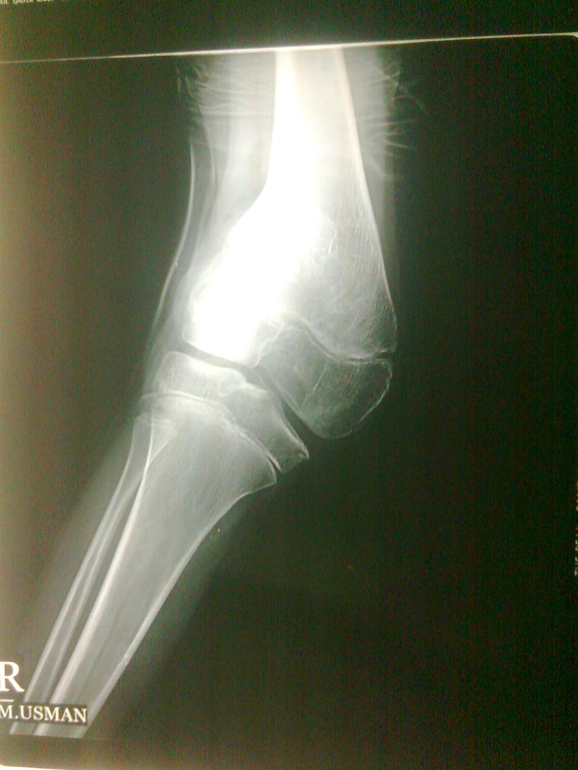 Knee Dislocation - Trauma - Orthobullets