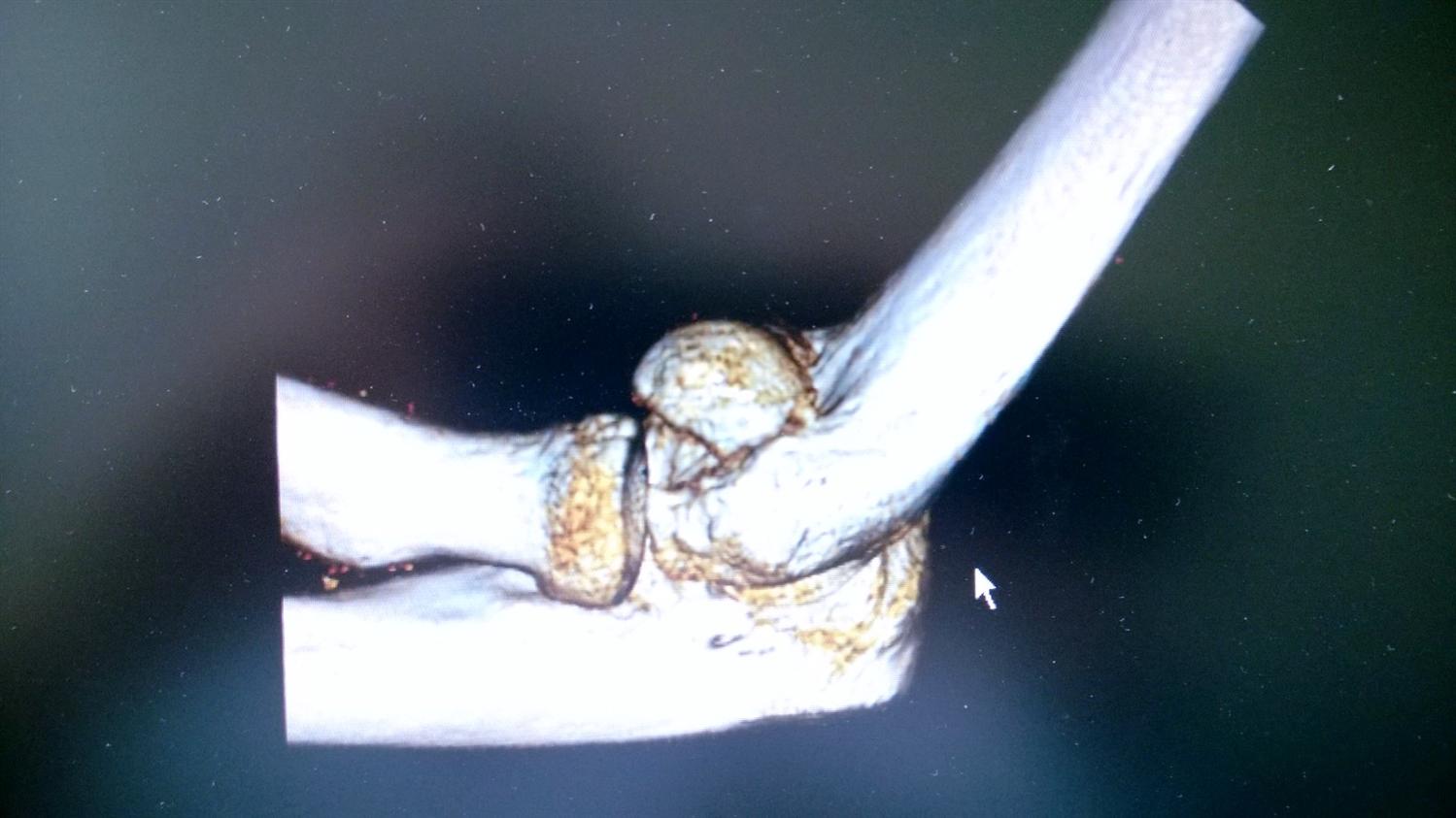 Capitellum Fractures - Trauma - Orthobullets