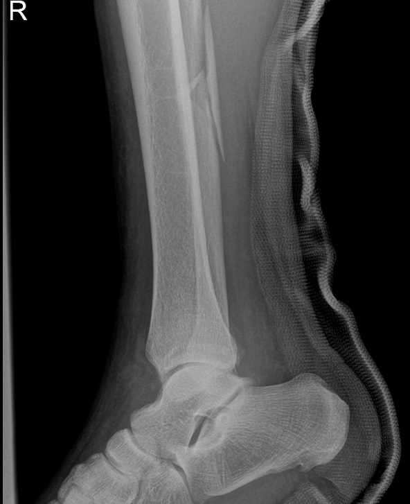 Ankle Fractures - Trauma - Orthobullets.com