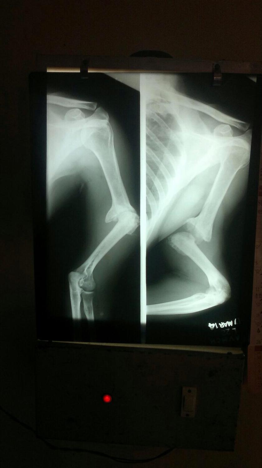 Humeral Shaft Fractures - Trauma - Orthobullets