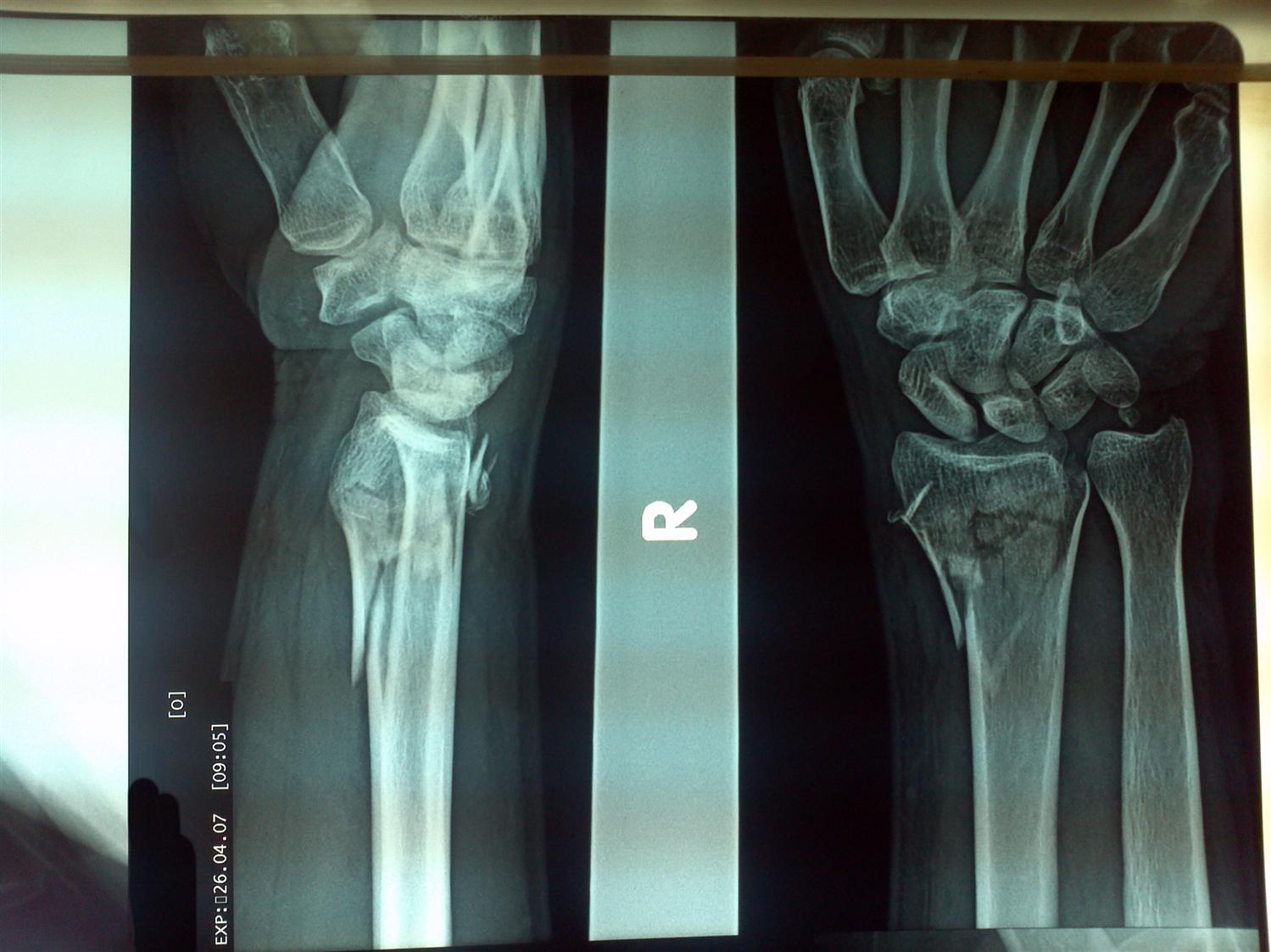 Distal Radius Fractures - Trauma - Orthobullets