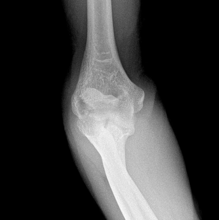 Distal Humerus Fractures - Trauma - Orthobullets