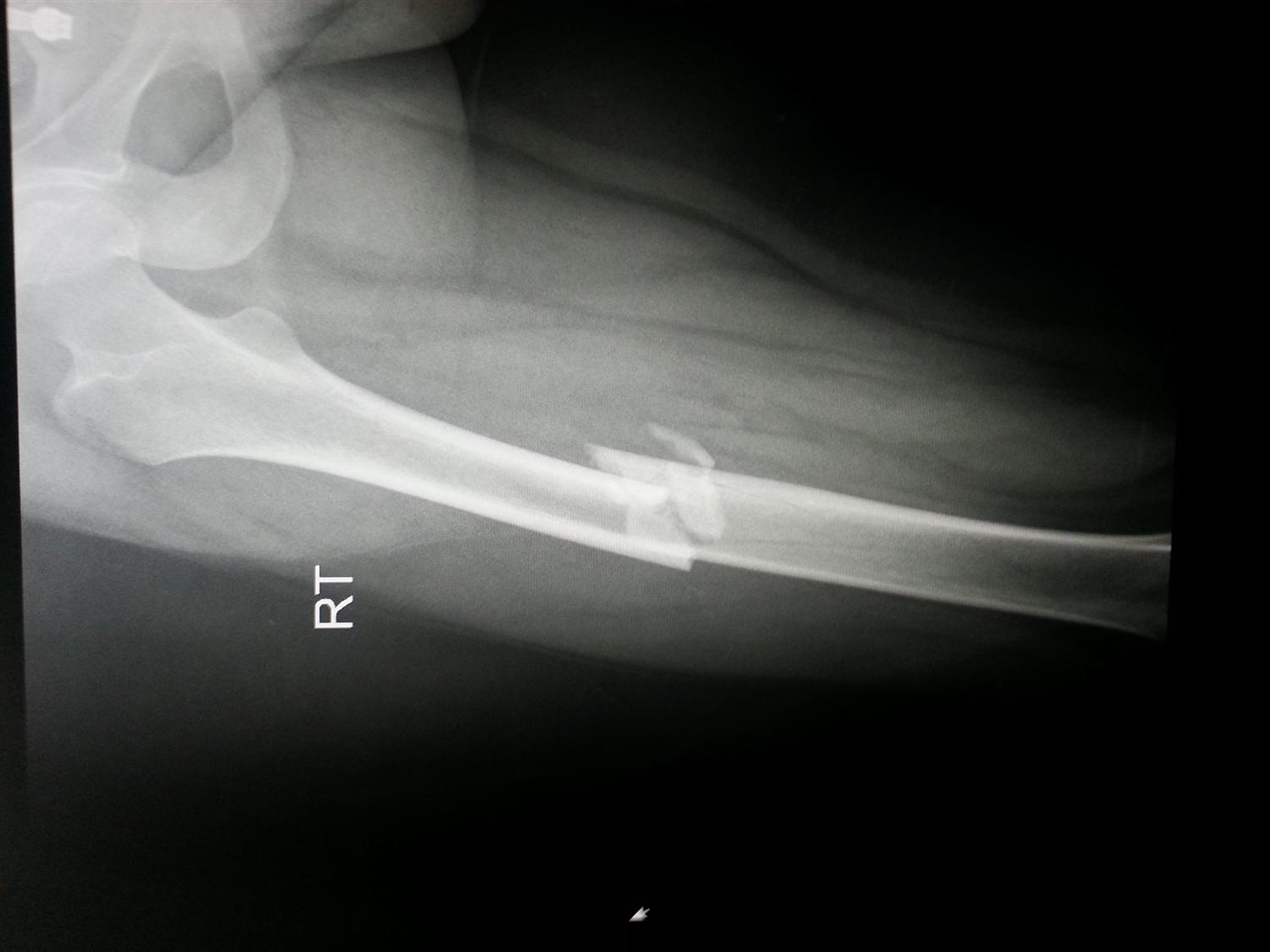 Proximal Third Tibia Fracture - Trauma - Orthobullets