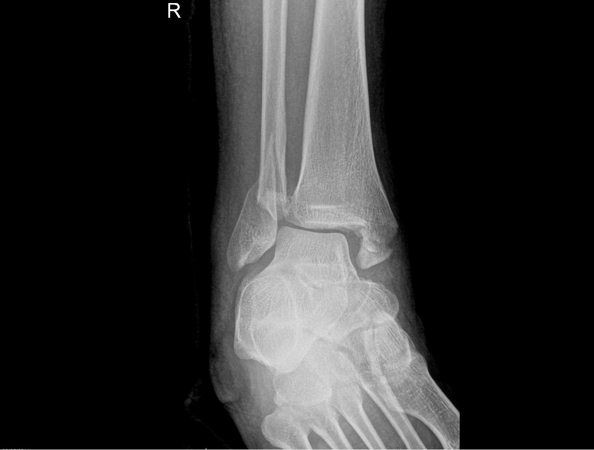 Ankle Fractures - Trauma - Orthobullets.com