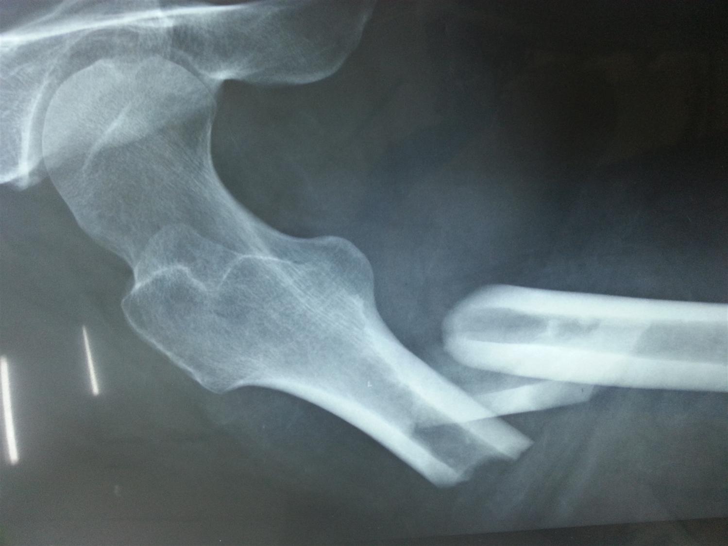 Subtrochanteric Fractures - Trauma - Orthobullets