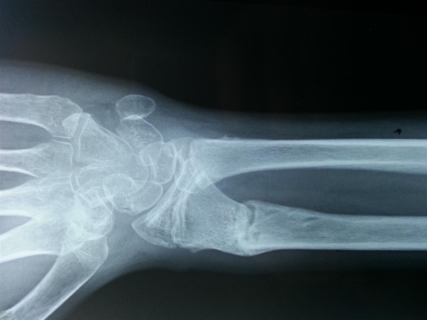 Distal Radius Fractures - Trauma - Orthobullets