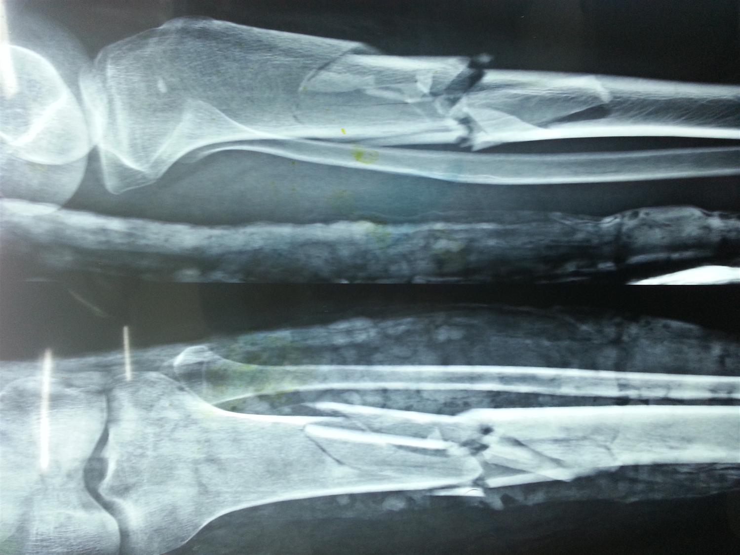 Tibia Shaft Fractures - Trauma - Orthobullets.com
