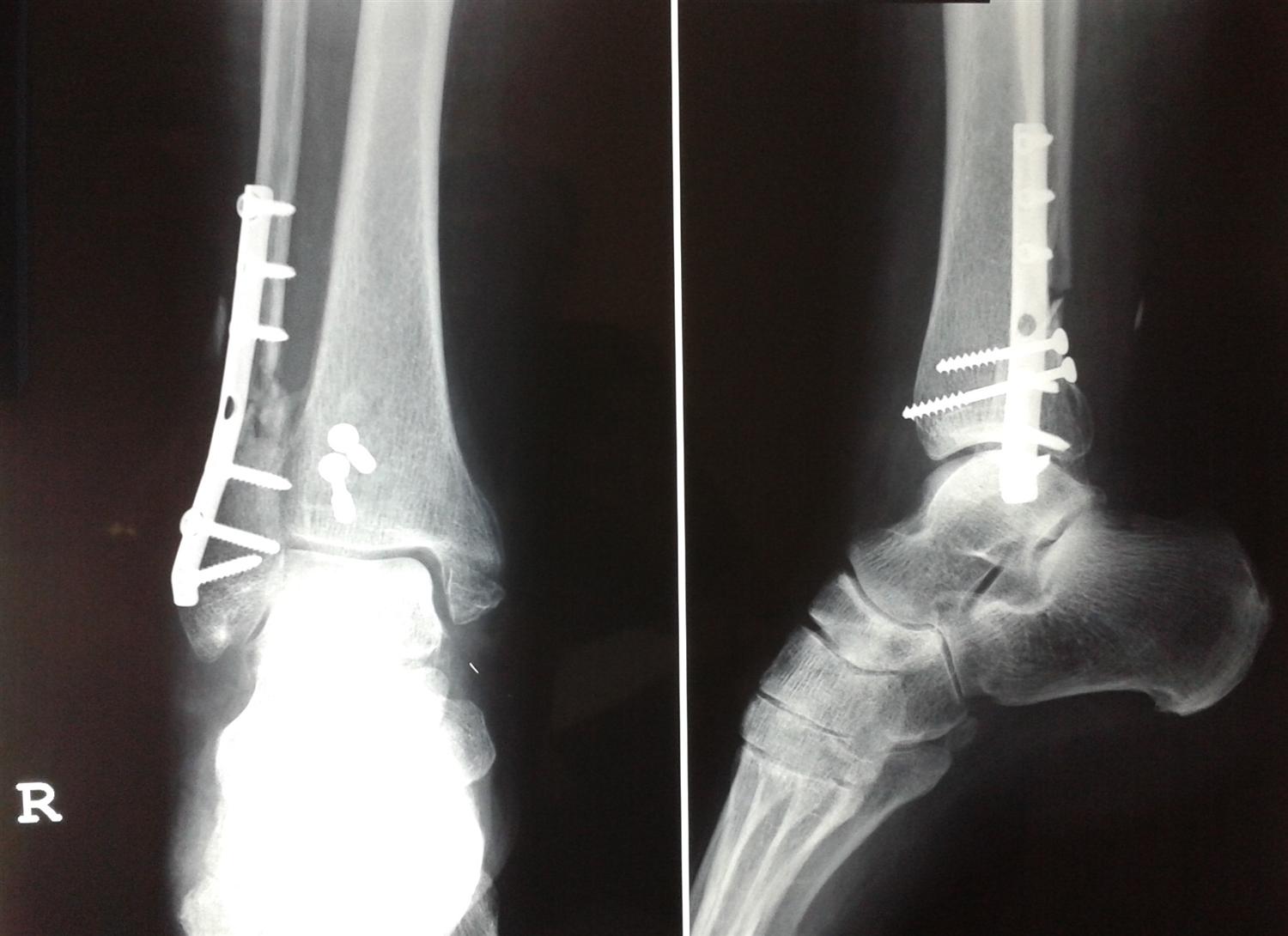 Ankle Fractures - Trauma - Orthobullets.com