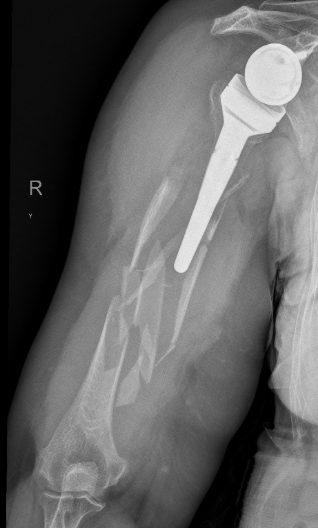 Humeral Shaft Fractures - Trauma - Orthobullets