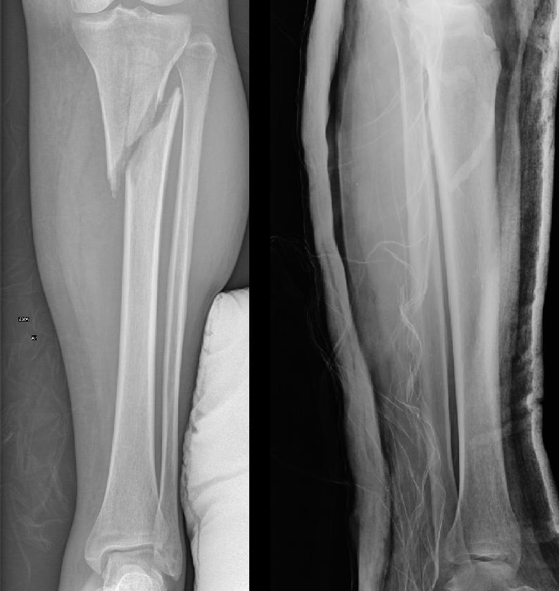 Tibia Shaft Fractures - Trauma - Orthobullets.com