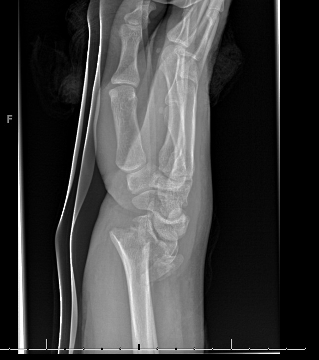 Distal Radius Fractures - Trauma - Orthobullets