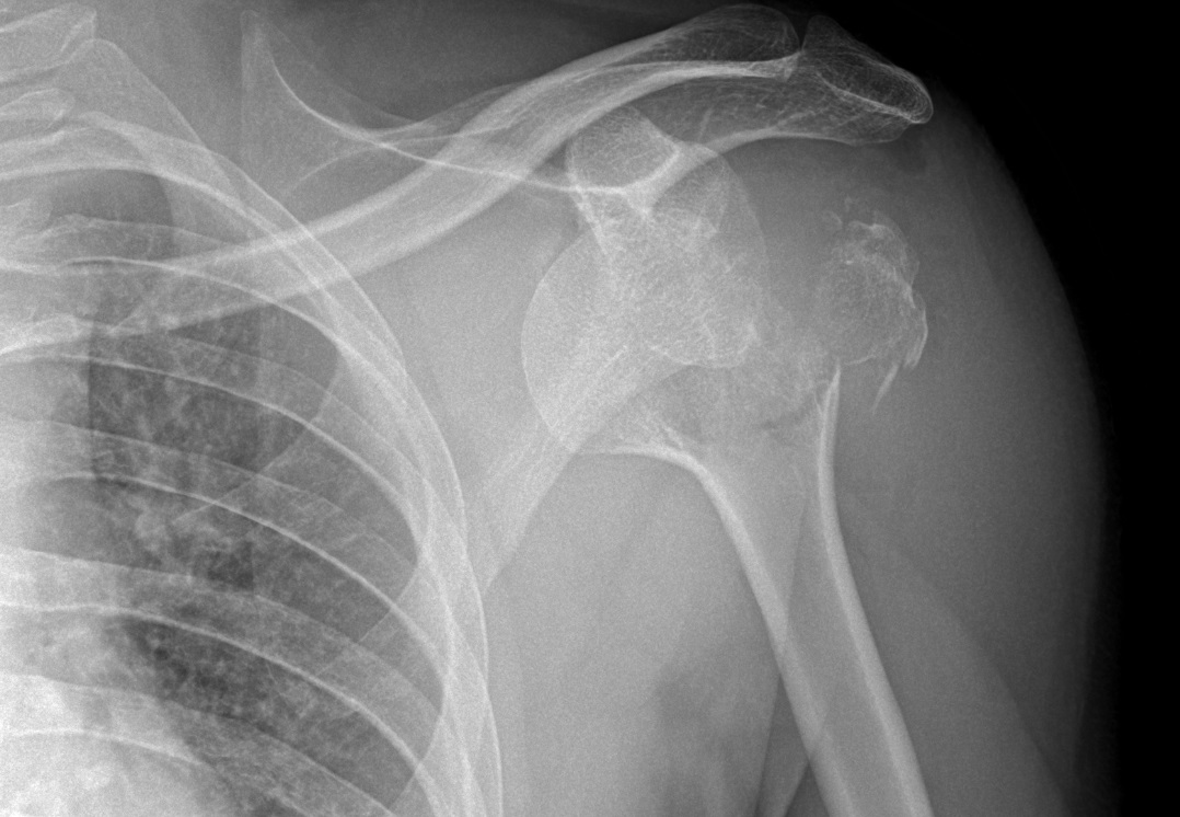 Proximal Humerus Fractures - Trauma - Orthobullets