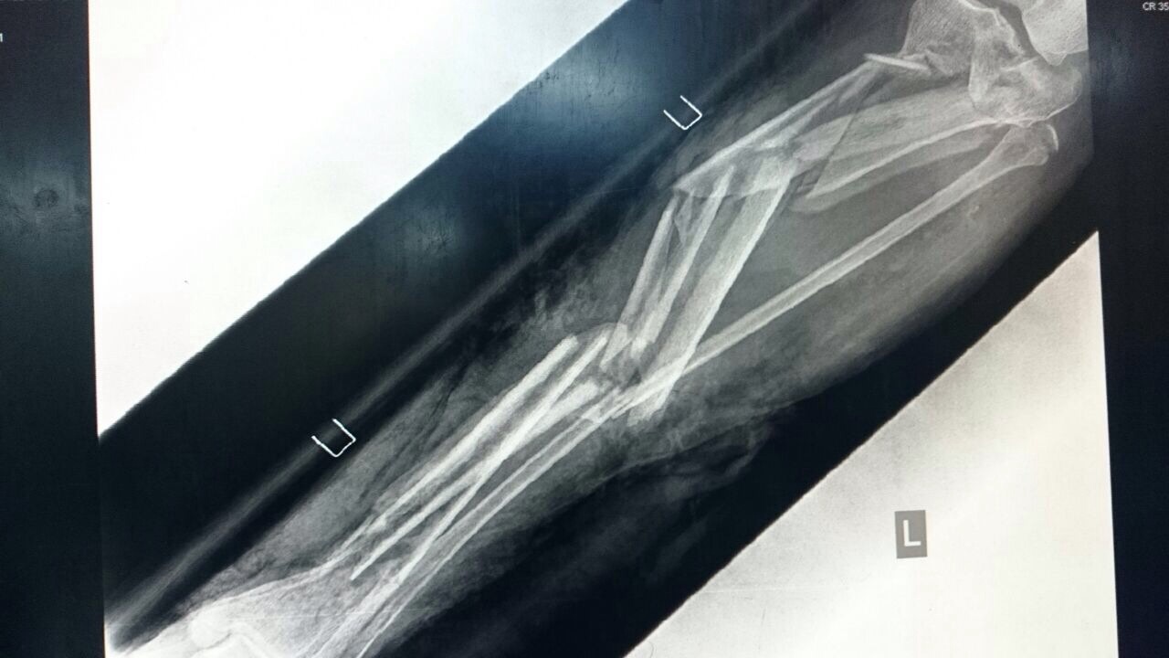 Open Fractures Management - Trauma - Orthobullets