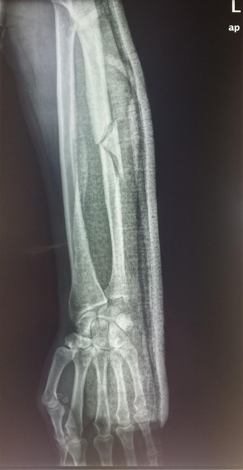 Radius and Ulnar Shaft Fractures - Trauma - Orthobullets