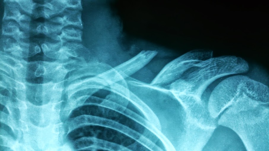 Distal Third Clavicle Fractures Trauma Orthobullets Midshaft Clavicle