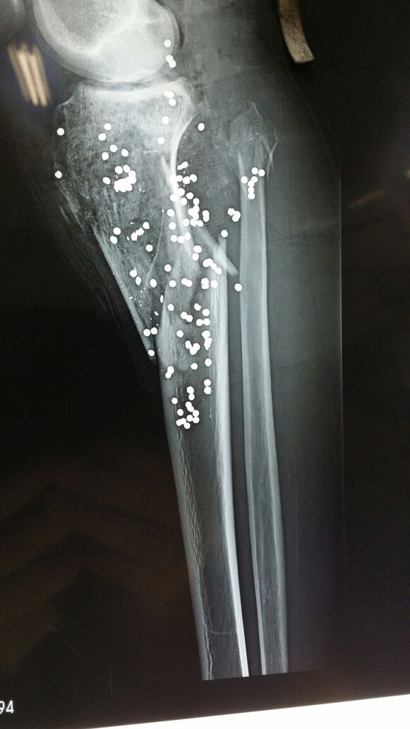 Proximal Third Tibia Fracture - Trauma - Orthobullets