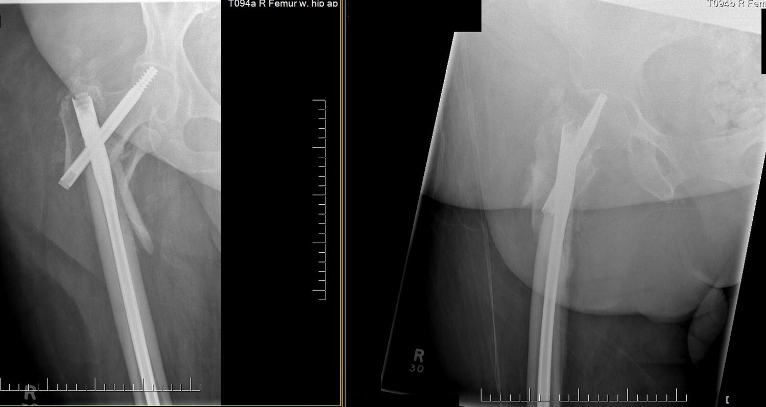 Subtrochanteric Fractures - Trauma - Orthobullets