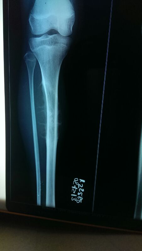 Aneurysmal Bone Cyst - Pathology - Orthobullets