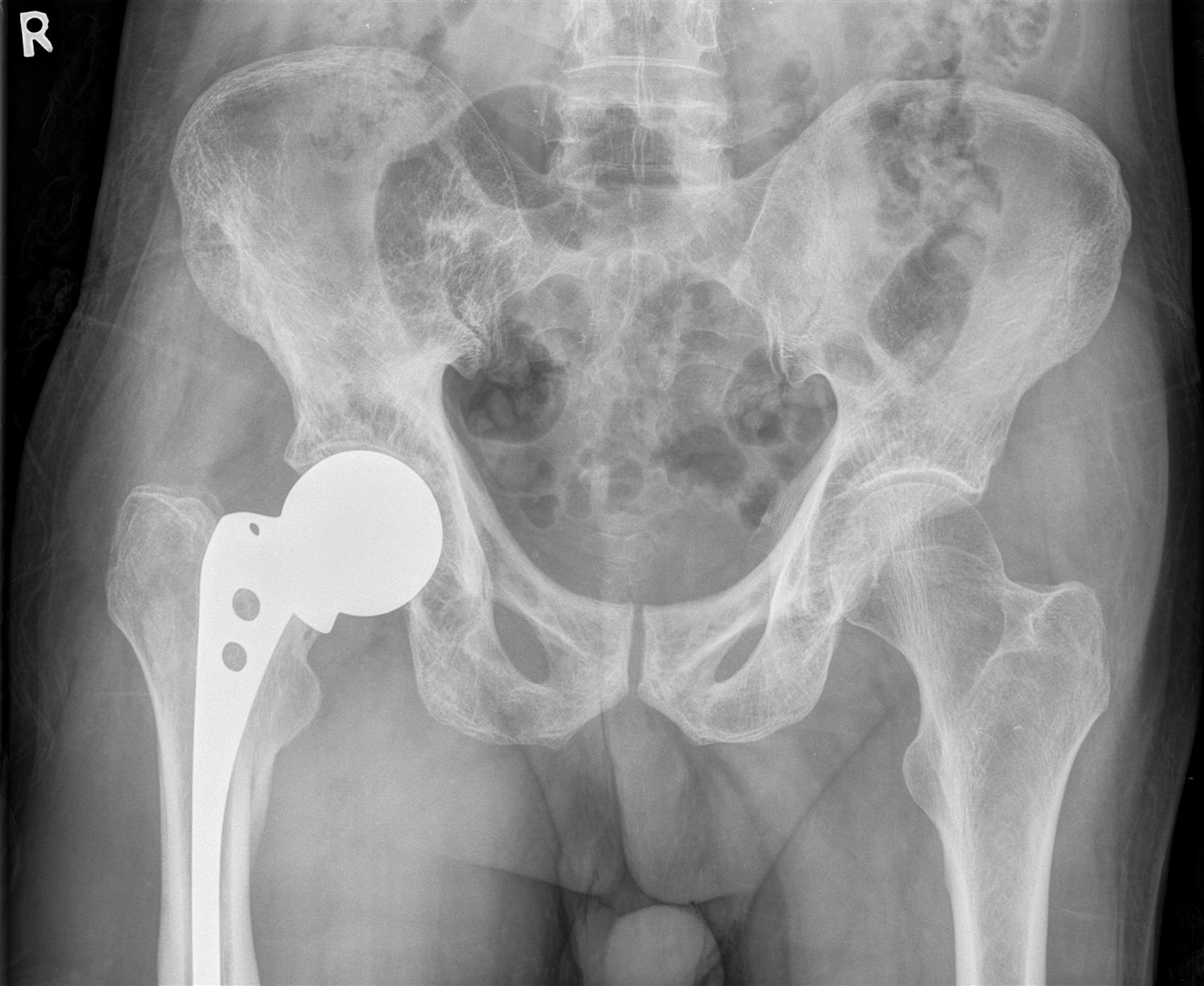 THA Periprosthetic Fracture - Recon - Orthobullets