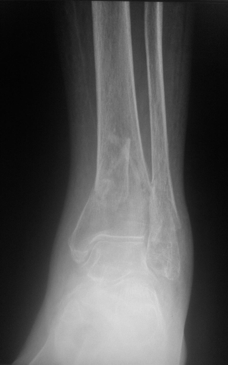 Tibial Plafond Fractures - Trauma - Orthobullets