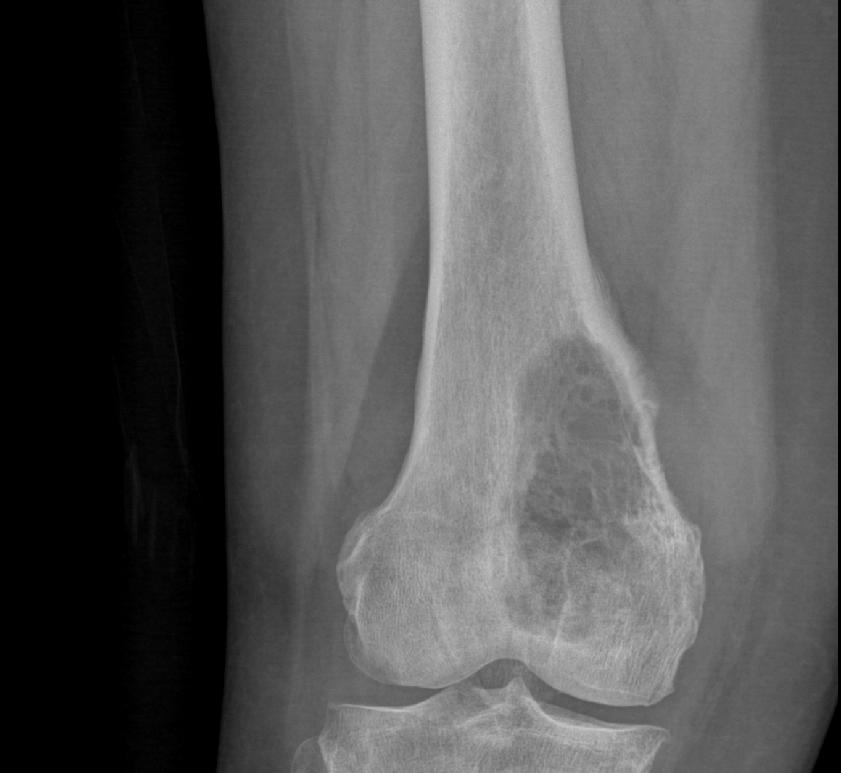 Leiomyosarcoma - Pathology - Orthobullets